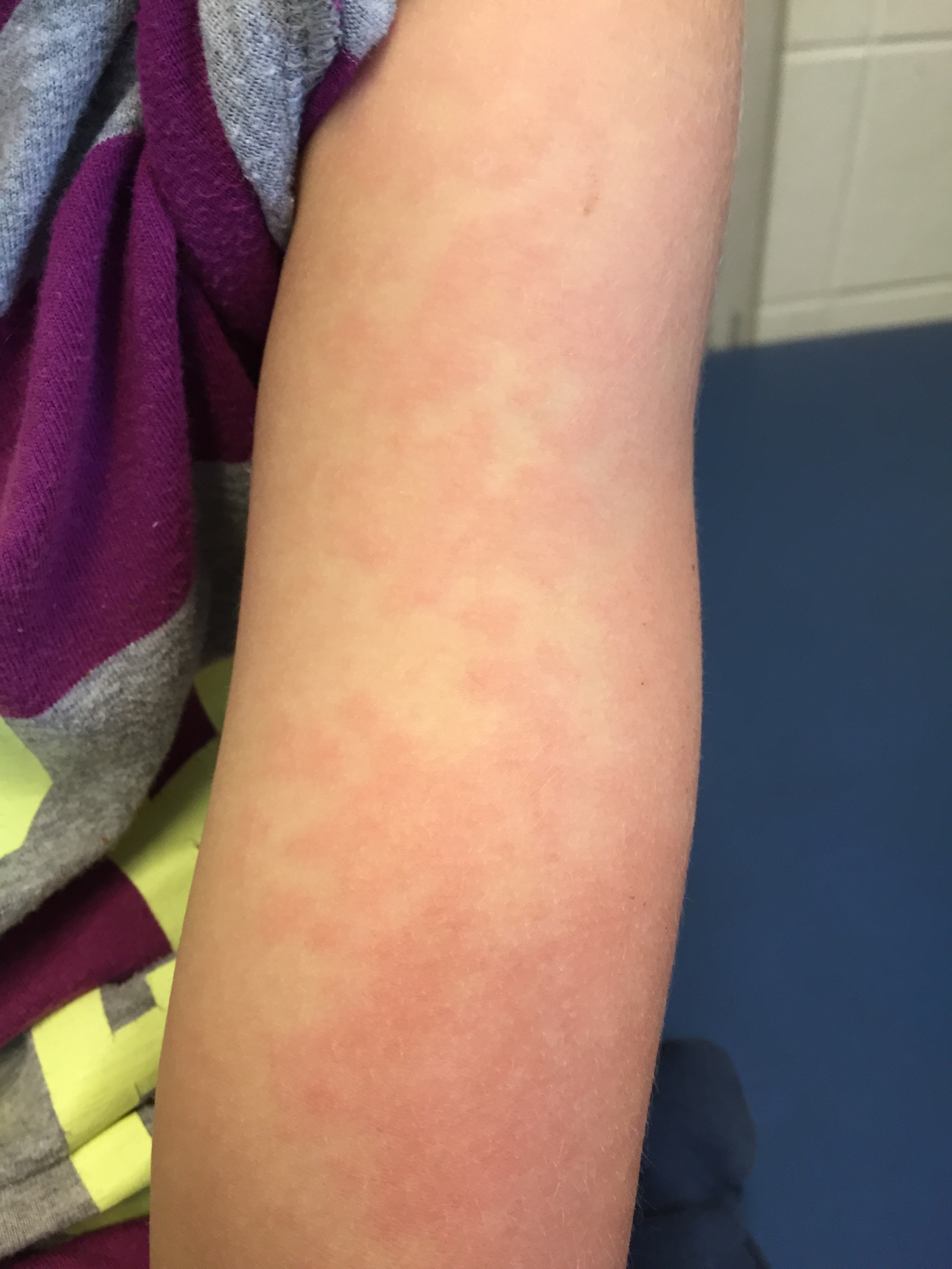Ringelröteln (Erythema infectiosum) - Kinderarzt Prien